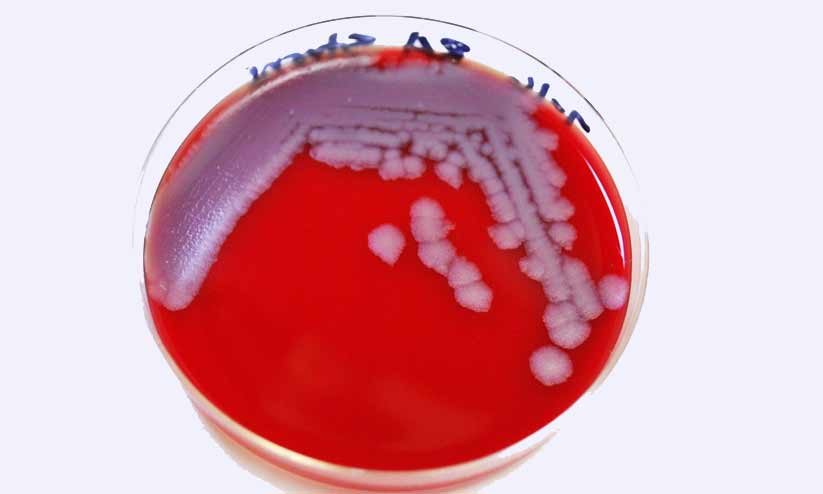 ശ്വാസനാളിയിലെ ആന്ത്രാക്സ് മരണത്തിനിടയാക്കും; ഈ ലക്ഷണങ്ങളെ ...