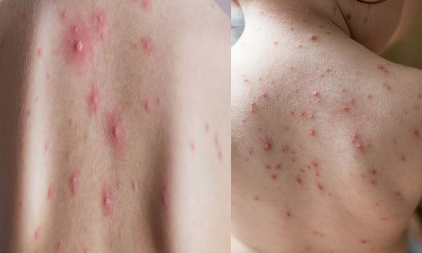 ചിക്കൻ പോക്സ്: സി.ഇ.ടി ഈമാസം 15 വരെ അടച്ചു | Chicken Pox: CET closed ...